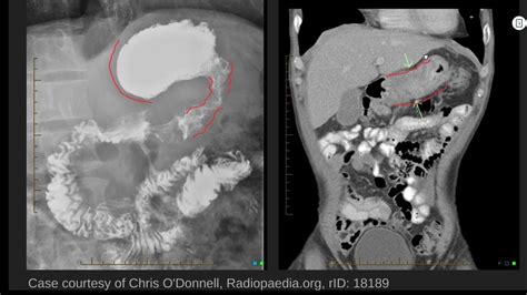 Linitis Plastica Radiology Youtube