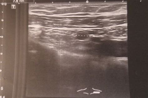 Rak piersi jak wygląda leczenie nowotworu w Polsce Część 1 biopsja