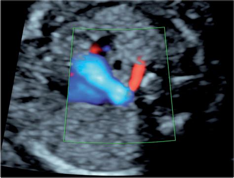The Visualization Of The Arsa At The 3 Vessel Tracheal View Download