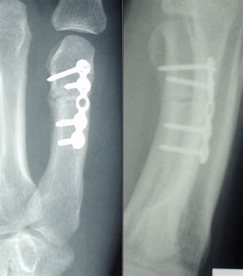 The Correction Obtained With Closing Wedge Osteotomy Download