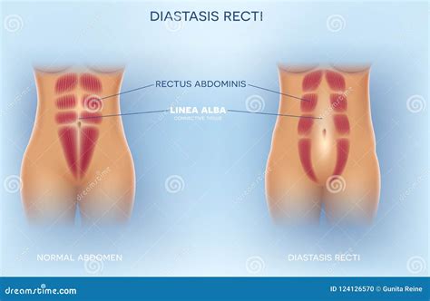 Diastasis Recti Abdominal Separation Medical Vector Illustration