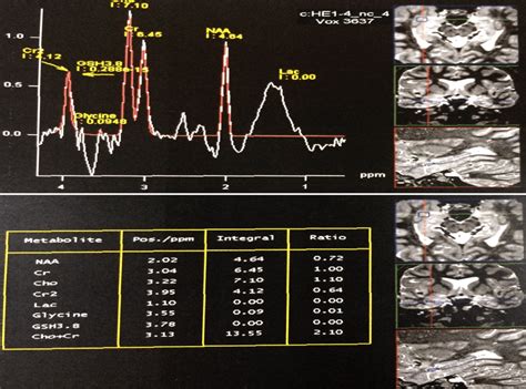 Spectral Mr Spectroscopy Peaks And Relevant Brain Metabolites