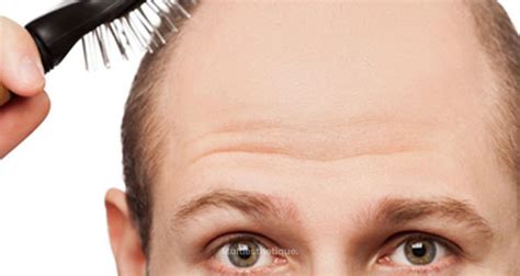 Quels Sont Les Stades De La Calvitie Multiesthetique Fr