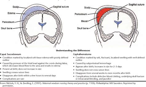 Caput Succedaneum Caput Succedaneum Swelling Clinical