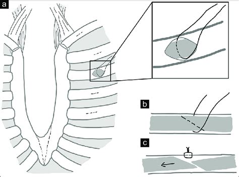 Schematic Representation To Perform Sliding Costal Chondrotomy And
