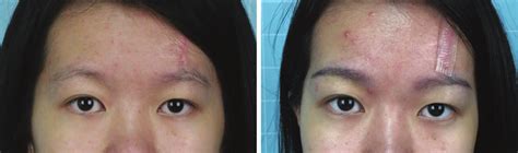 Outcomes In A 20 Year Old Woman With Partial Left Eyebrow Loss Download Scientific Diagram
