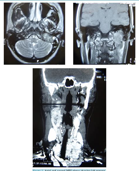 Set Of Anterior Jugulo Omohyoid Lymph Nodes Semantic Scholar