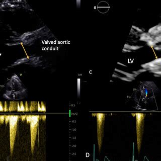 Transthoracic Echocardiography Long Axis Parasternal View With Same