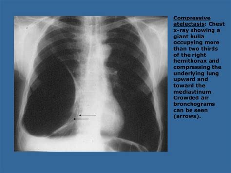 Ppt Atelectasis Powerpoint Presentation Id6185976 Ppt Atelectasis Powerpoint Presentation Id6185976