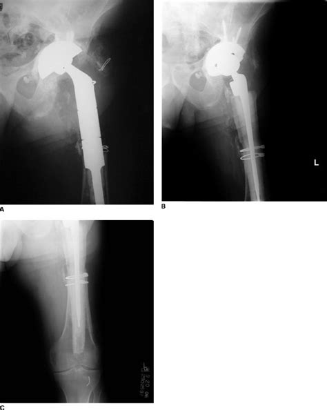 Allograft Prosthetic Composite Musculoskeletal Key
