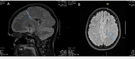 A Sagittal And B Transverse Mri Demonstrating Numerous Small