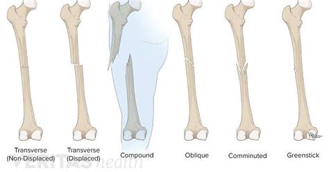 Fractures Medizzy