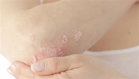 Dry Bumpy Rash