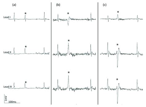 Representative Ectopic Beats Recorded In Mice Using Lead I Ii And Iii Download Scientific