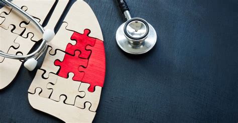 Adjuvant Alectinib Found To Be Effective In Early Stage Alk Positive