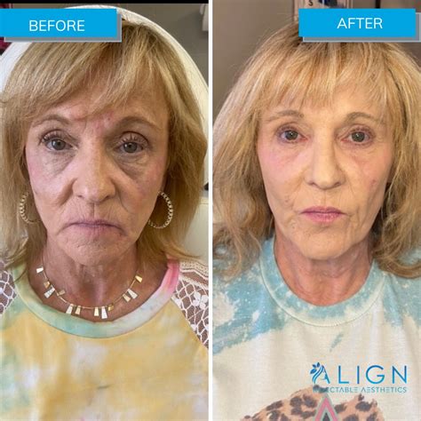 Eye Bag Surgery Before And After Xuas