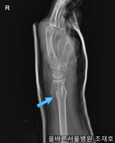 심하게 분쇄된 원위 요골 및 척골 골절에서의 관혈적 정복술 및 내고정술뼈이식술orif At Comminuted Distal