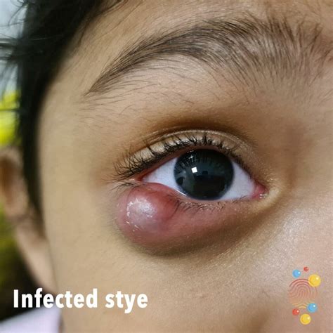 Stye Eye Getting Worse At Julian Mcneil Blog