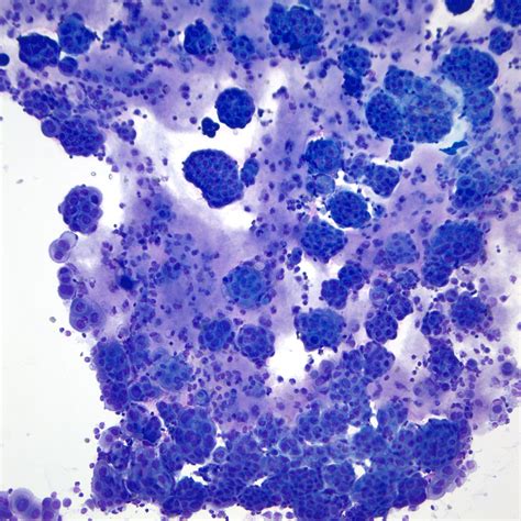 Mesothelioma Cytology