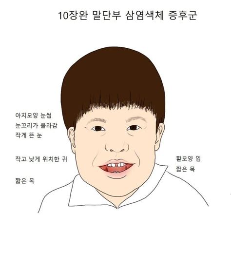증후군별 생김새 특징 Mlbpark