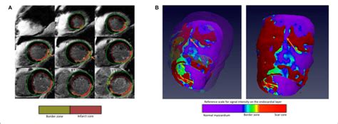 Scar Mapping A Short Axis Two Dimensional Segmentation Of Scar