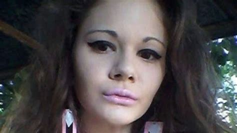 Im Unrecognisable After Having 30 Injections To Get The Worlds