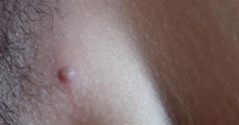 Pimple Or Something Else Pic Album On Imgur