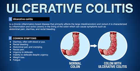 Ulcerative Colitis Symptoms Infographic Stock Illustration Download