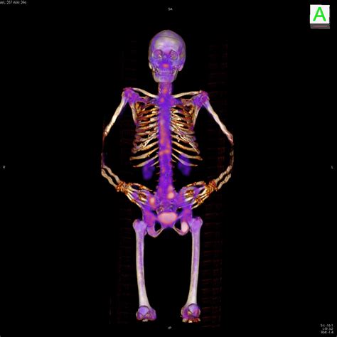 Nuclear Medicine Studies Whole Body Bone Spect Ct Scans For Cancer