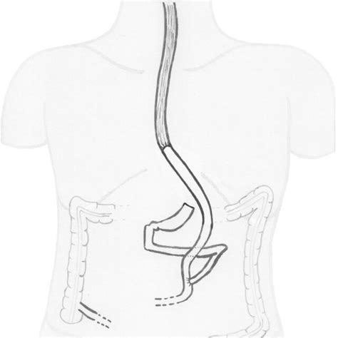 Planned Reconstruction Double Tract Reconstruction Eso Jejunal Download Scientific Diagram