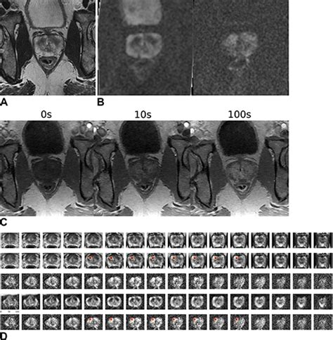 Fully Automated Ai Model Detects Prostate Cancer On Mri Applied Radiology