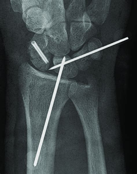 Posteroanterior Postoperative Radiograph Showing Fixation Of The Download Scientific Diagram