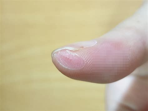 양배추 채칼에 손가락 베임 3주 경과