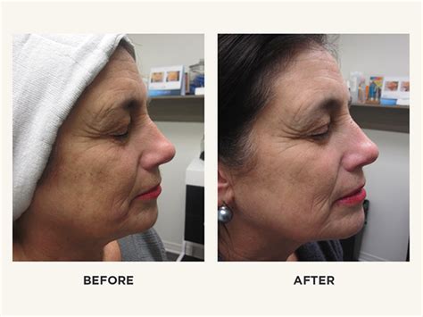 Venus Freeze Facial Treatment Of Espace Skins Montreal Skin And