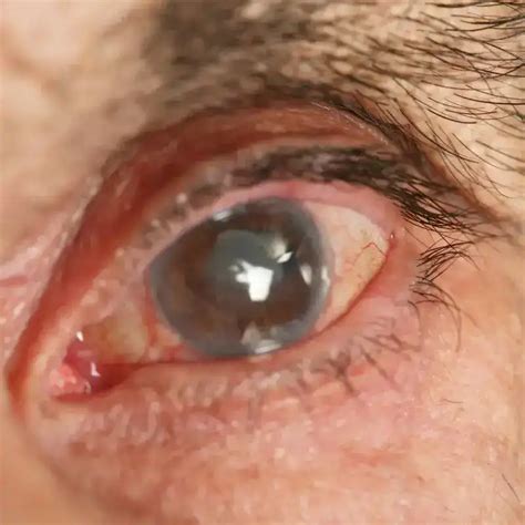 Nuclear Cataract Causes And Management Healthok Global