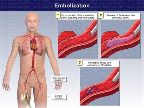 Embolization Trialquest Inc