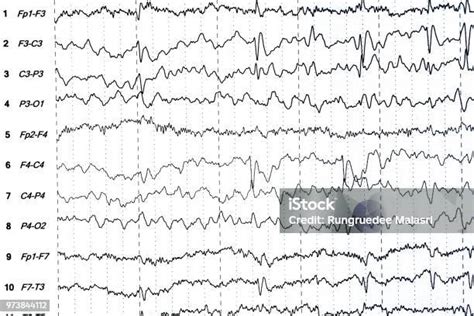뇌 파 뇌 파의 소아 환자 뇌의 전기 활동에 문제에 뇌 파 패턴 건강관리와 의술에 대한 스톡 사진 및 기타 이미지 건강관리와 의술 과학 그래프 Istock