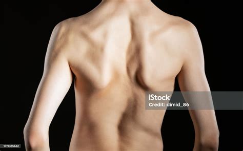 검은 배경에 척추의 심한 곡률을 가진 젊은이 척추측만증 치료 곡선에 대한 스톡 사진 및 기타 이미지 곡선 척추 신체 부분