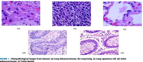 Figure 1 From Malignancy Detection In Lung And Colon Histopathology