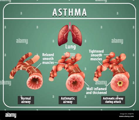 Asthma Diagram With Normal Airway And Asthmatic Airway Illustration Stock Vector Image And Art Alamy