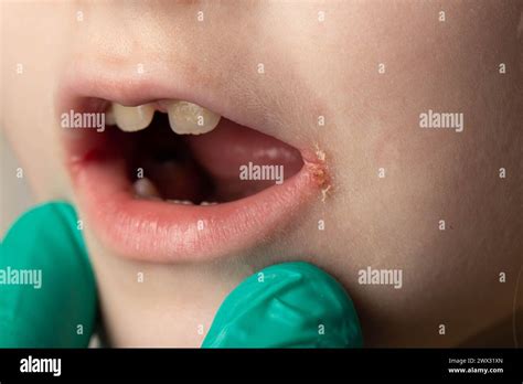 A Doctor Wearing Medical Gloves Examines The Mouth And Lip Jams Of A