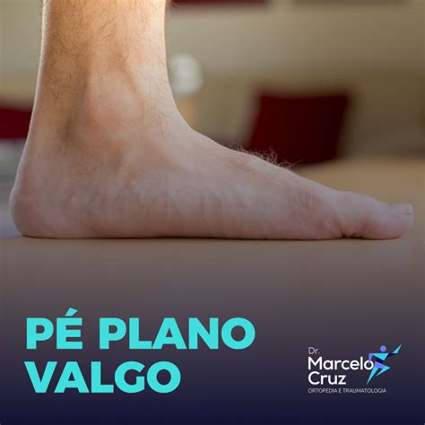 Saiba O Que é Pé Plano Valgo Dr Marcelo Cruz