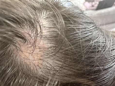 Lifelong Sensitivered Patch On Scalp Rdermatologyquestions