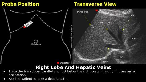 Caudate Lobe Of Liver Ultrasound