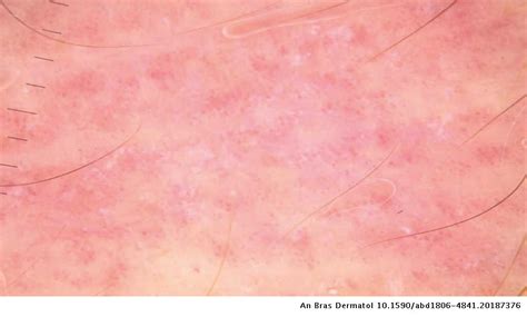 Acquired Elastotic Hemangioma A Little Known Entity Report Of A Case With 15 Years Of
