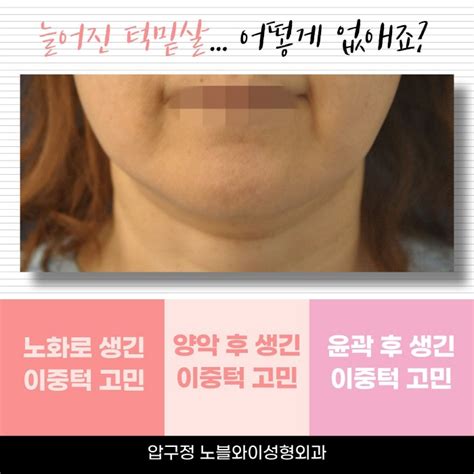 턱밑살 빼는법 중 이중턱 리프팅 수술 어떨까