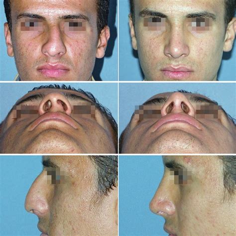 4 Left Preoperative Patient With A Left Caudal Dislocation Causing