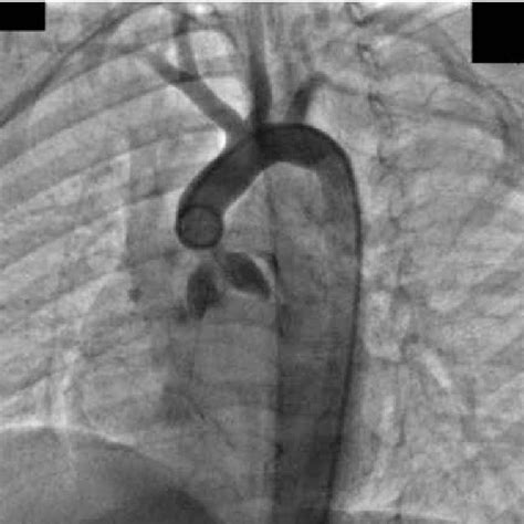 Aorta After Implantation Of The Three Sinus Patches Case 1
