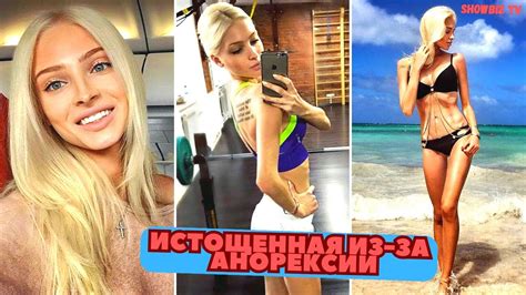 АЛЁНА ШИШКОВА СДЕЛАЛА ЛИПОСАКЦИЮ И ПЛАСТИЧЕСКУЮ ОПЕРАЦИЮ ВСЕ