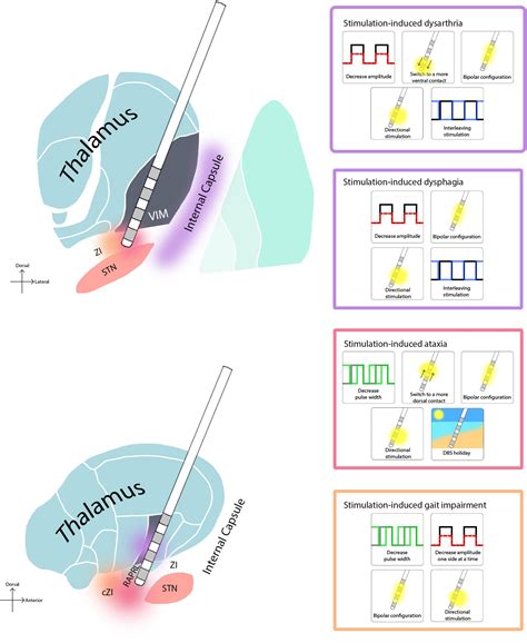 Management Of Essential Tremor Deep Brain Stimulation Induced Side
